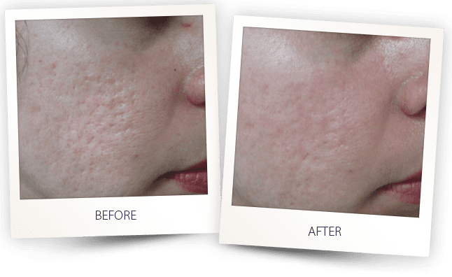 ClearLift 4D Laser Facelift - Andresa Aesthetics | Exclusive Skin ...