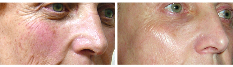 ClearLift 4D Laser Facelift - Andresa Aesthetics | Exclusive Skin ...
