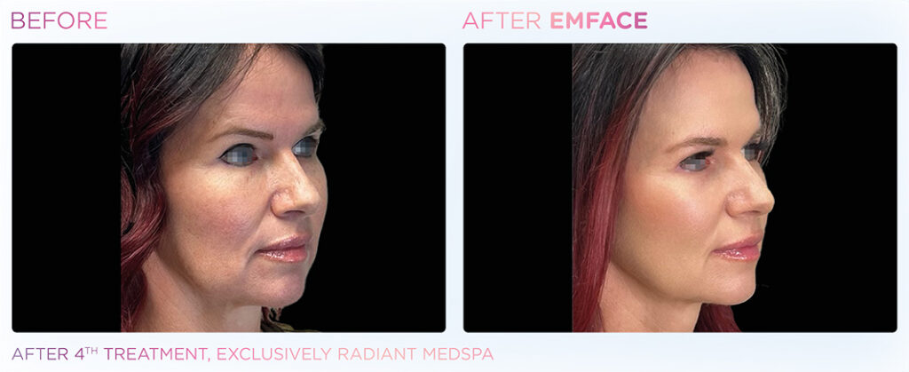 BTL EMface - Andresa Aesthetics | Exclusive Skin Health and Laser ...