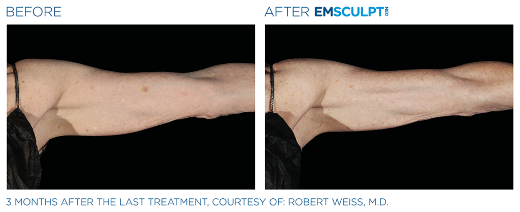 EM Sculpt Laser Clinic | EM Sculpt Laser Treatment | EM Sculpt Neo