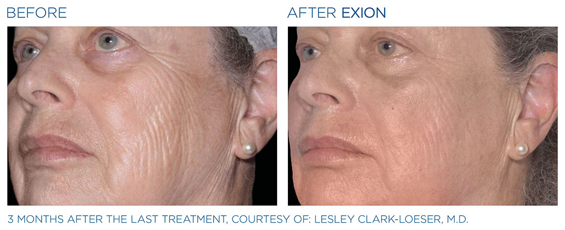 EXION Fractional (RF) - Andresa Aesthetics | Exclusive Skin Health and ...