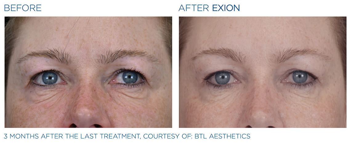 EXION Face | Treatment for Wrinkles | EXILIS Skin Rejuvenation