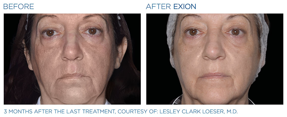 EXION Face | Treatment for Wrinkles | EXILIS Skin Rejuvenation