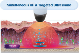 EXION Face | Treatment for Wrinkles | EXILIS Skin Rejuvenation